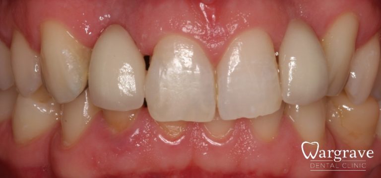 Dental Bridges - Wargrave Dental Clinic