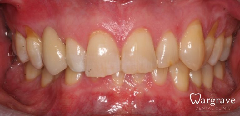 Dental Bridges - Wargrave Dental Clinic