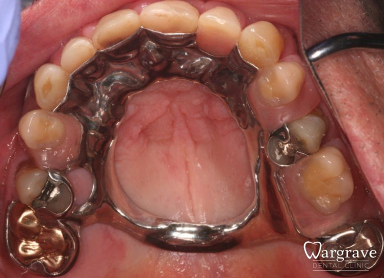 Partial Dentures - Wargrave Dental Clinic