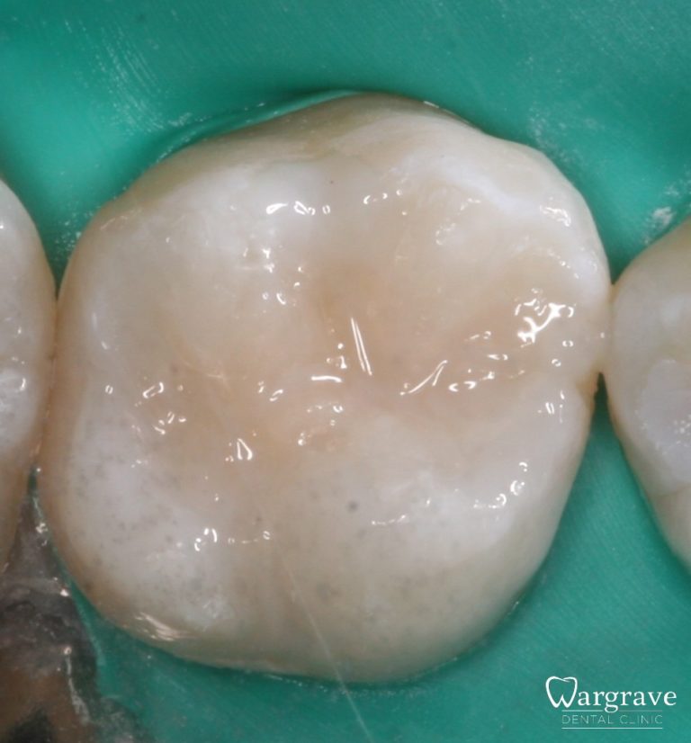 Tooth-coloured Restorations - Wargrave Dental Clinic